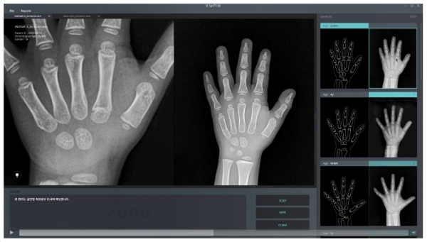 뷰노, AI CDSS 개발.."뼈 연령부터 심정지 예측까지" - 바이오스펙테이터